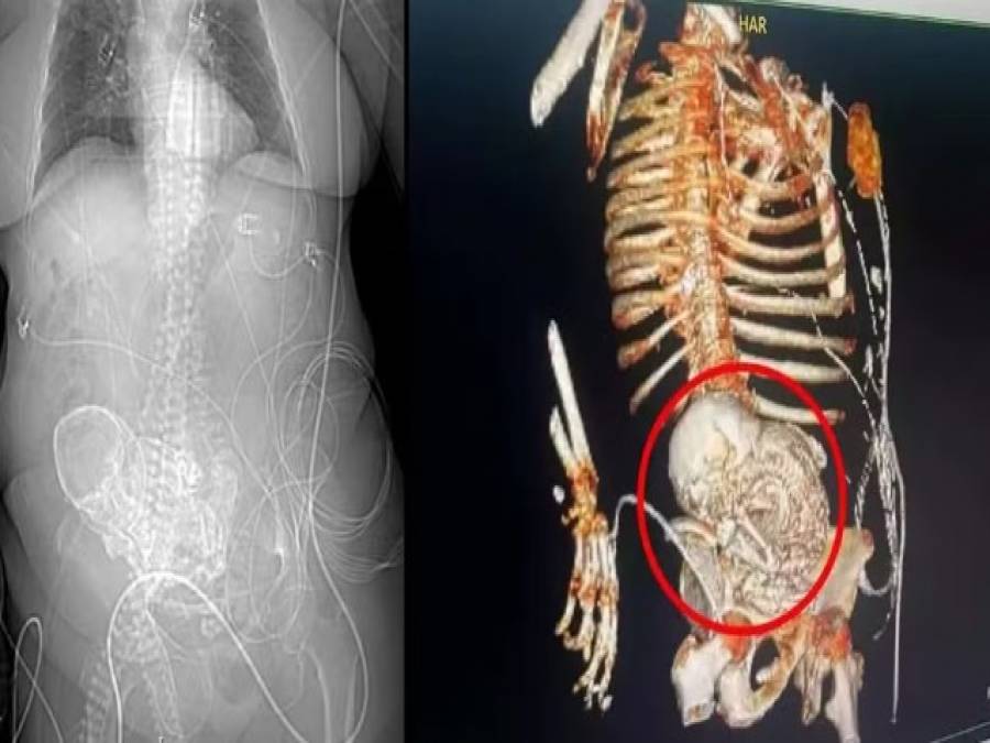 Idosa descobre feto calcificado que carregou por mais de cinco décadas ...