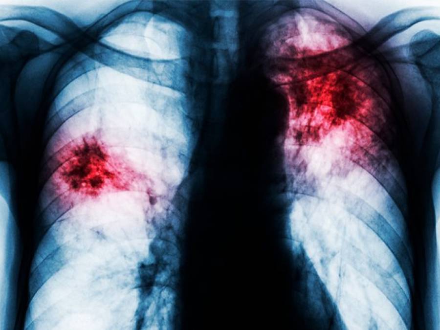 Tuberculose: o que é e quais são os sintomas, diagnóstico e tratamento ...